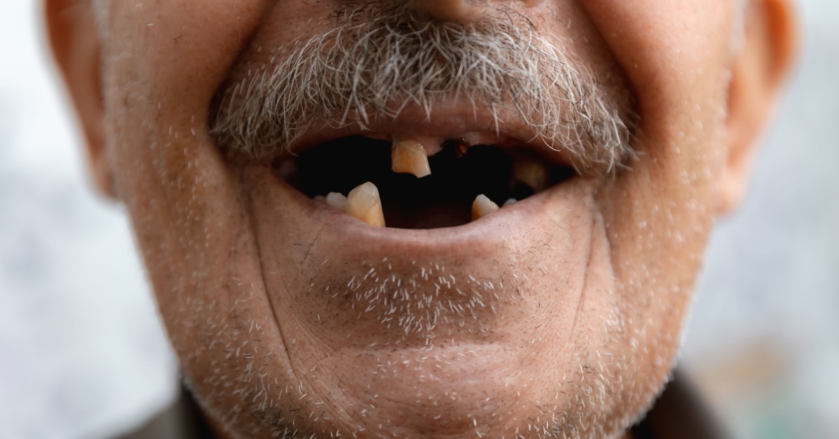 The effects of losing teeth on our facial appearance in Leicester ...